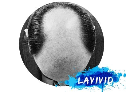 Information about Vertex Baldness and the Options You Have – LaVivid Hair