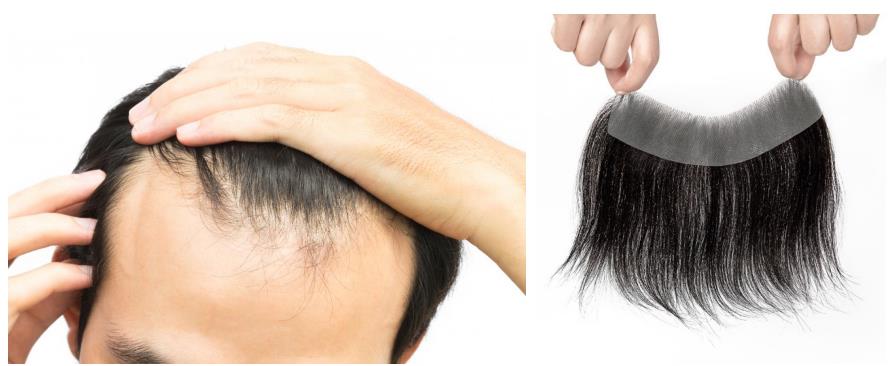 Hair Patches for Men! How Does It Work? - lavividhair