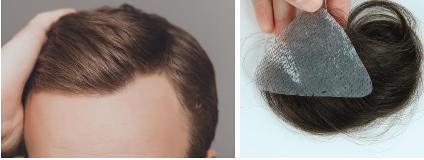 Hair Patches for Men! How Does It Work? - lavividhair