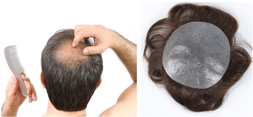 Hair Patches for Men! How Does It Work? - lavividhair