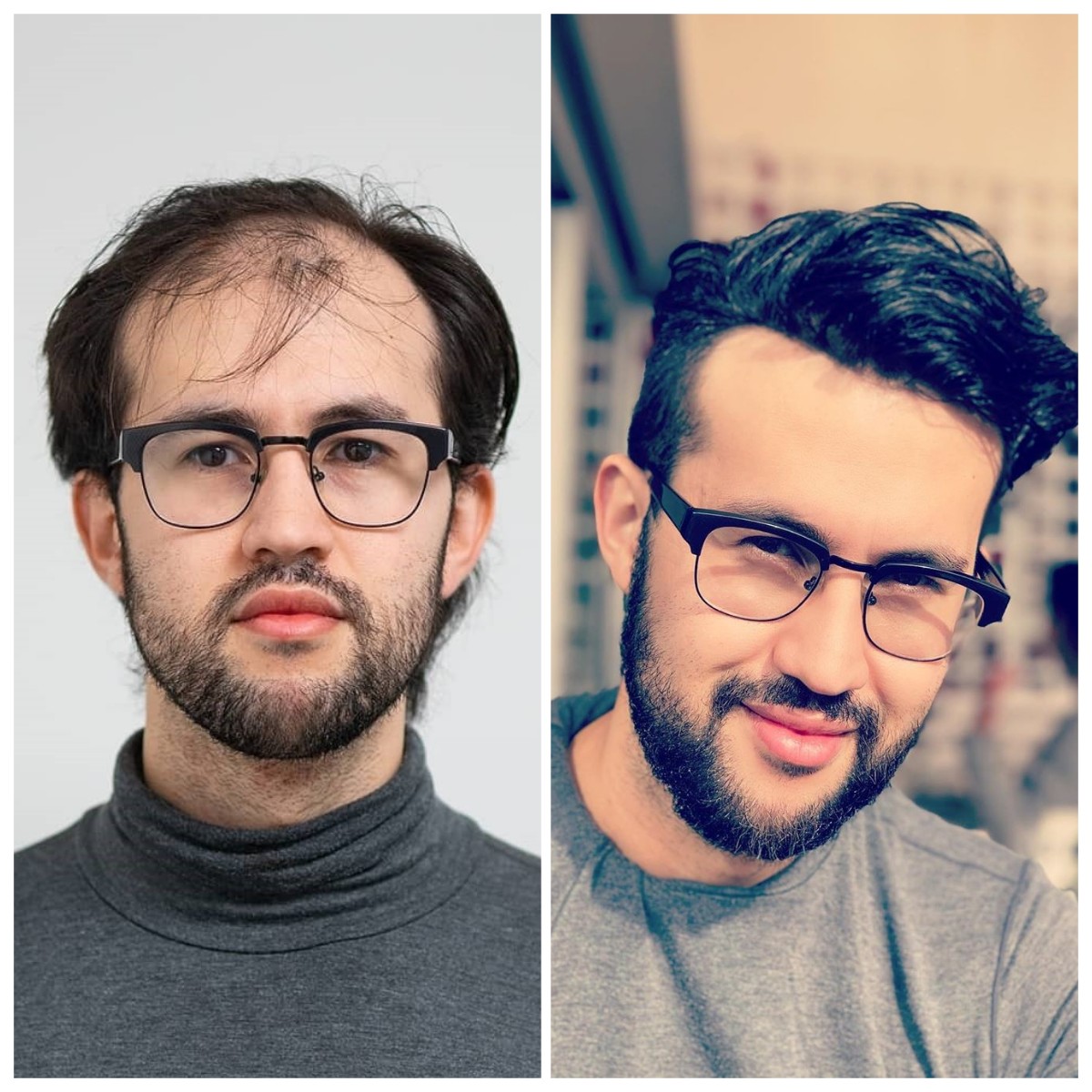 How to Make A Choice between Lace vs Poly Hair System? - lavividhair